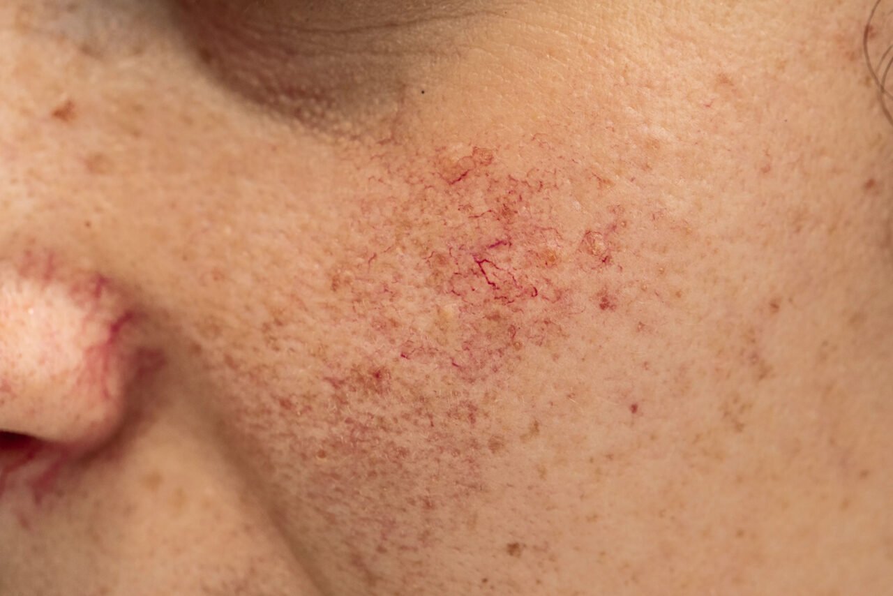 Vascular Lesions | Skin Lab Medspa