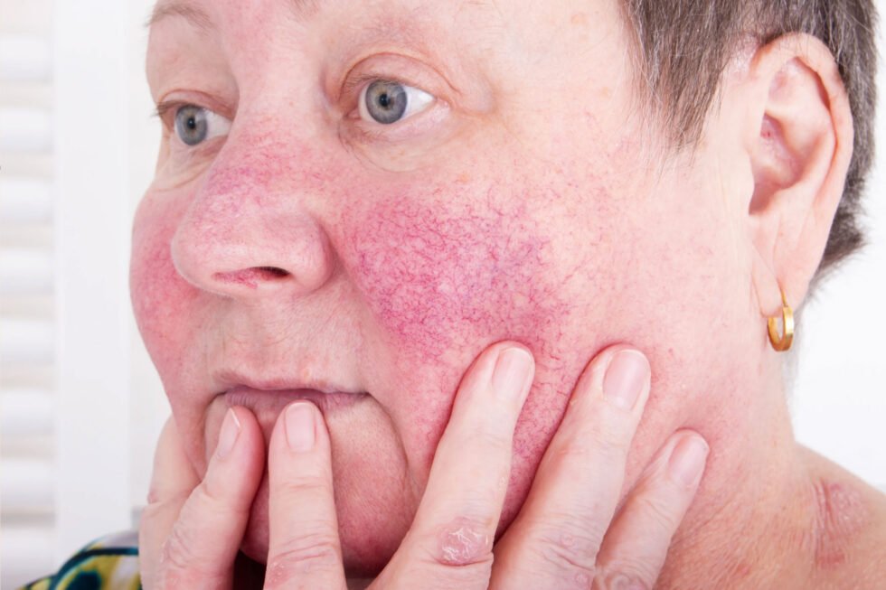 Vascular Lesions - Skin Lab Medspa