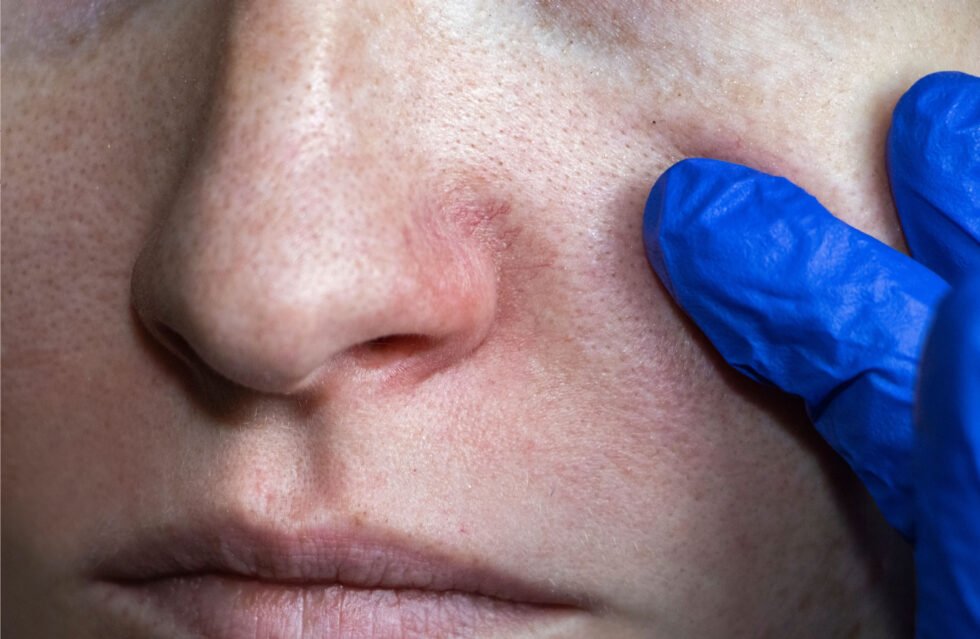 Vascular Lesions - Skin Lab Medspa